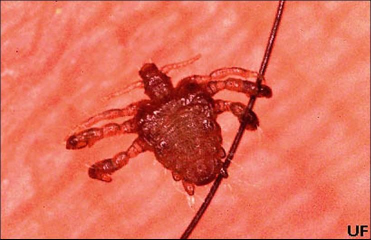 EENY-103/IN260: Crab Louse, Pthirus pubis (Linnaeus) (Insecta ...